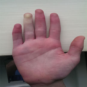 Hand Arm Vibration Syndrome (HAVS) explained and statistics